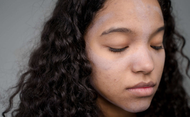 Guide To Common Facial Skin Conditions | UpCircle